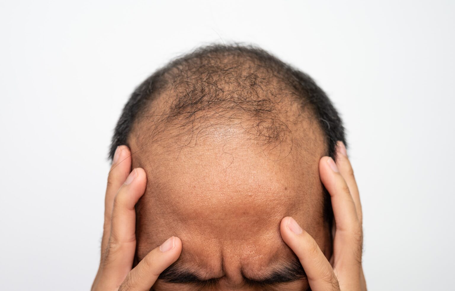 Stress and Hair Loss: What to Do Against It - Cosmedica Clinic