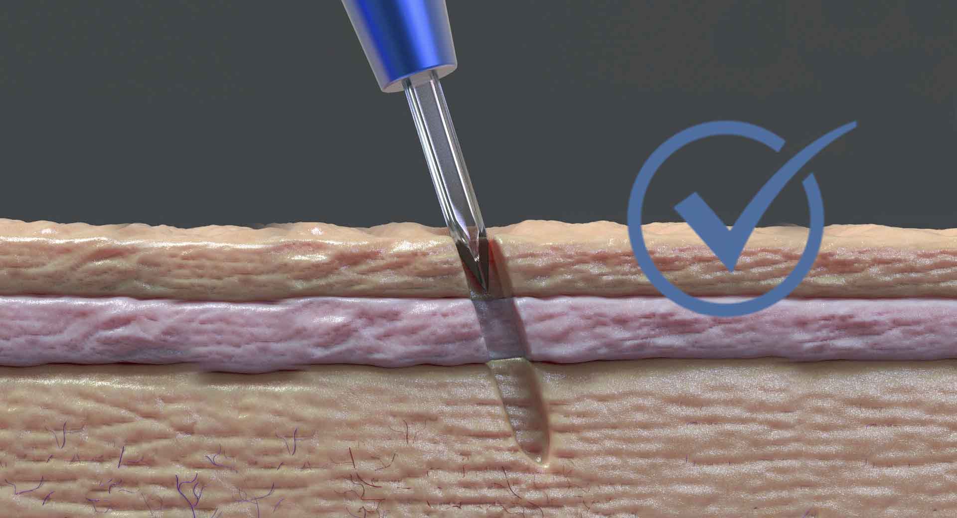 DHI Sapphire methode - Cosmedica Dr. Levent Acar