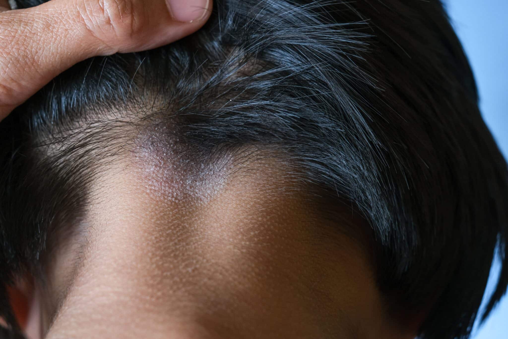 Scalp Fungus Hair Loss: What is it? | Cosmedica