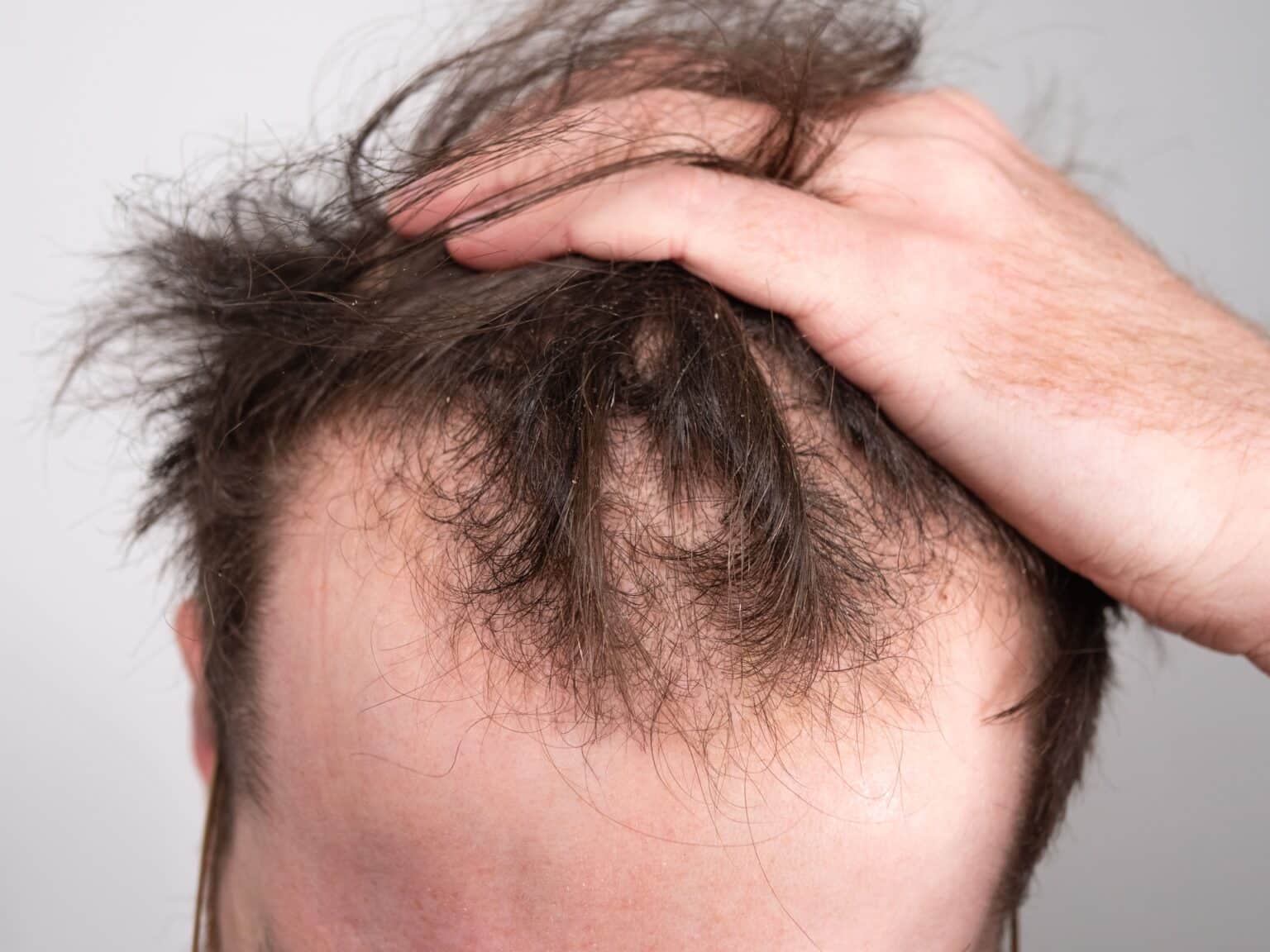 Norwood Scale: Classifying Male Pattern Baldness - Cosmedica Clinic