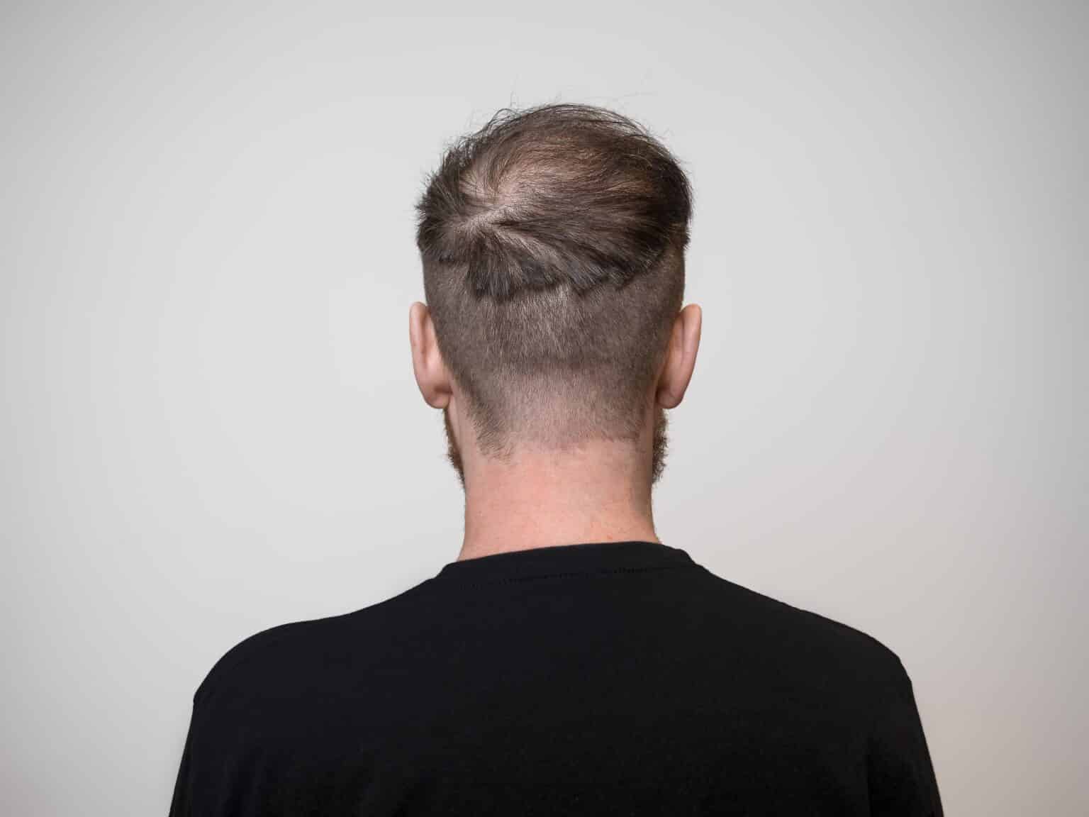 Norwood Scale: Classifying Male Pattern Baldness - Cosmedica Clinic
