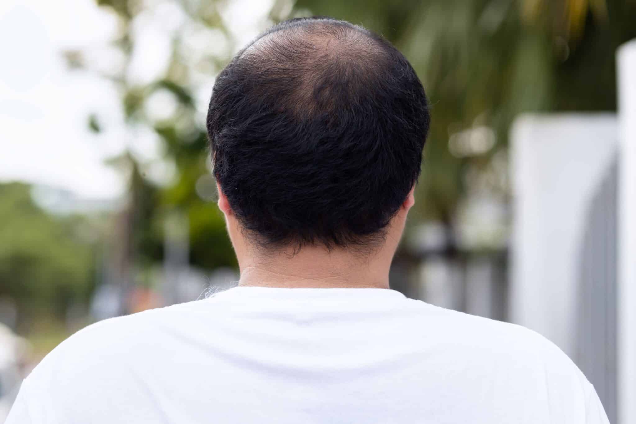 Norwood Scale: Classifying Male Pattern Baldness - Cosmedica