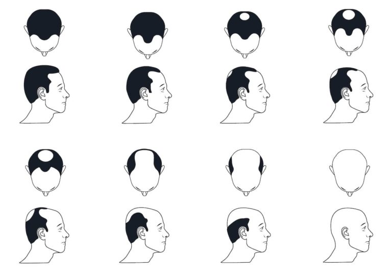 Ludwig Scale: The Classification for Female Pattern Baldness
