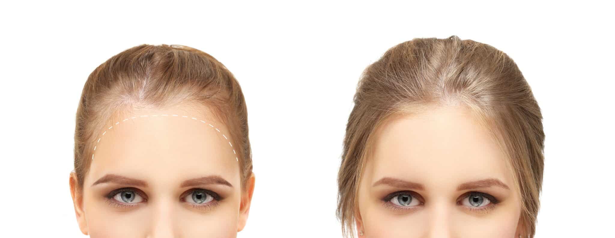 Ludwig Scale: The Classification for Female Pattern Baldness