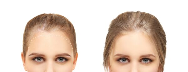 Ludwig Scale: The Classification for Female Pattern Baldness