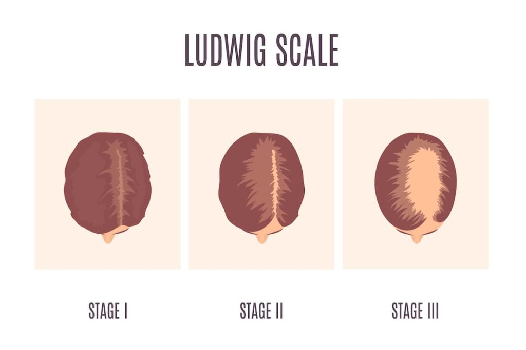 Norwood Scale: Classifying Male Pattern Baldness - Cosmedica