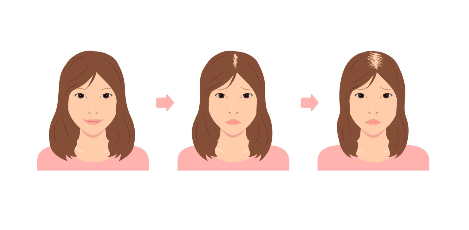 Ludwig Scale: The Classification for Female Pattern Baldness