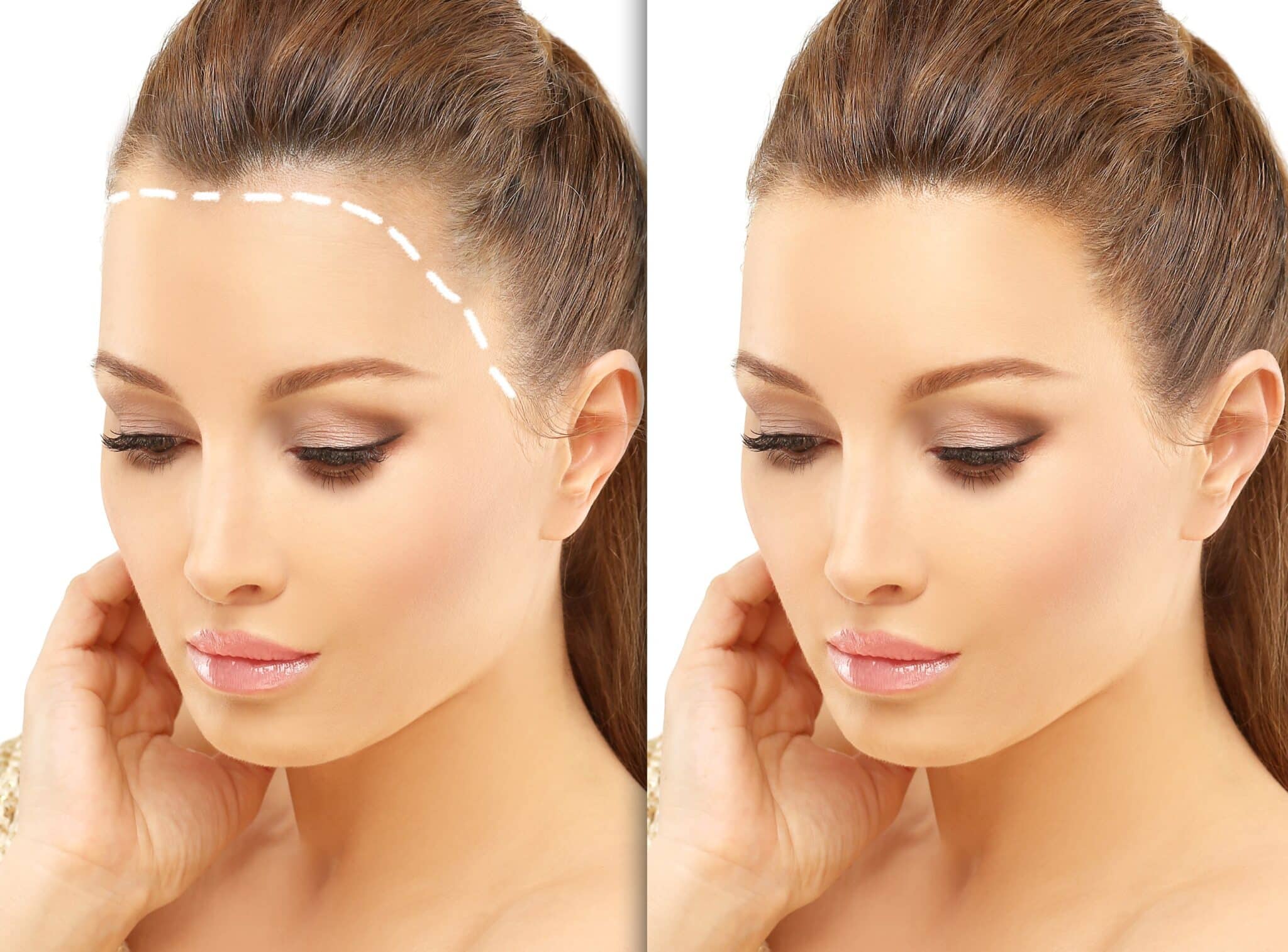 Artificial Hair Transplant: Pros, Cons and Realities - Cosmedica