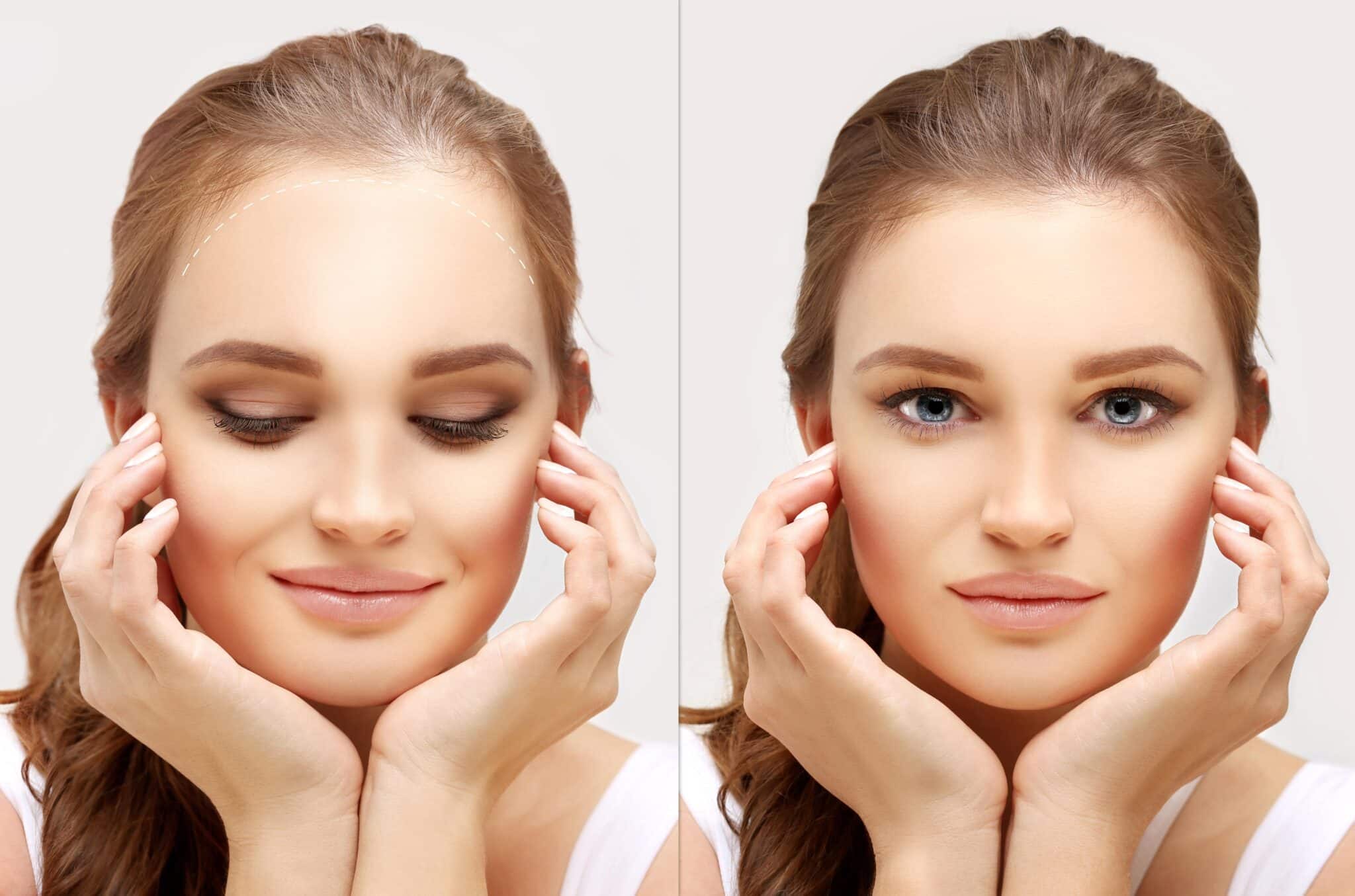 Frontal Fibrosing Alopecia: How to Handle It - Cosmedica