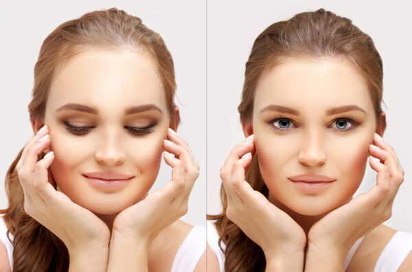 Frontal Fibrosing Alopecia: How to Handle It - Cosmedica