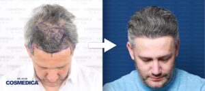 Hair Transplant Trypophobia: All You Should Know - Cosmedica