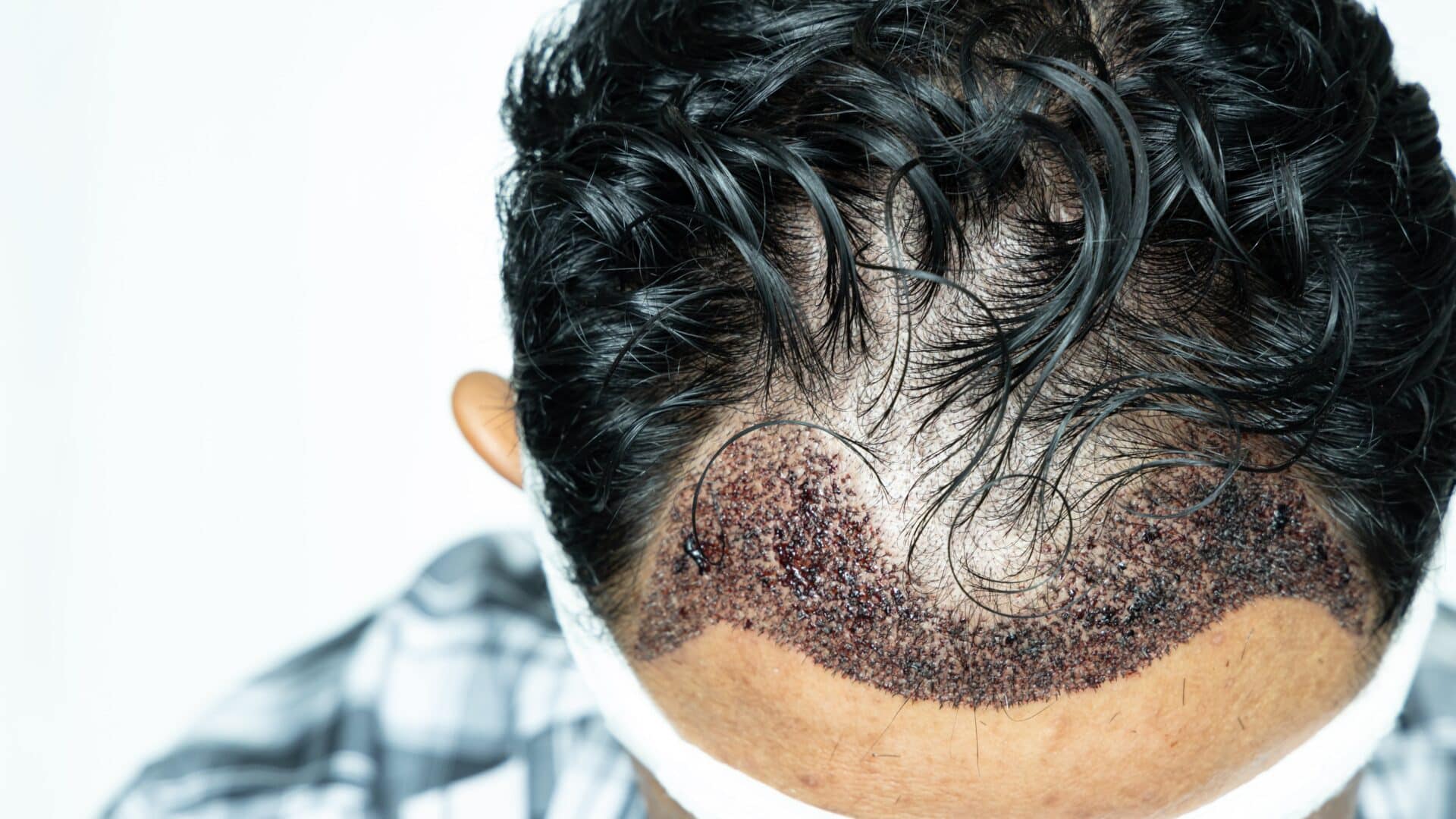 Hair Transplant Right After: Your Guide to Recovery - Cosmedica