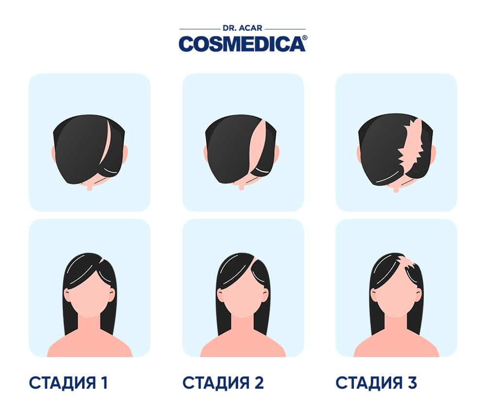 Vypadávání vlasů: Příčiny, typy a léčba - Cosmedica