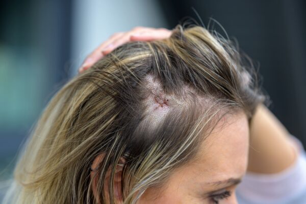 Fix Scar Hair: How to Grow Hair on Scars | Cosmedica