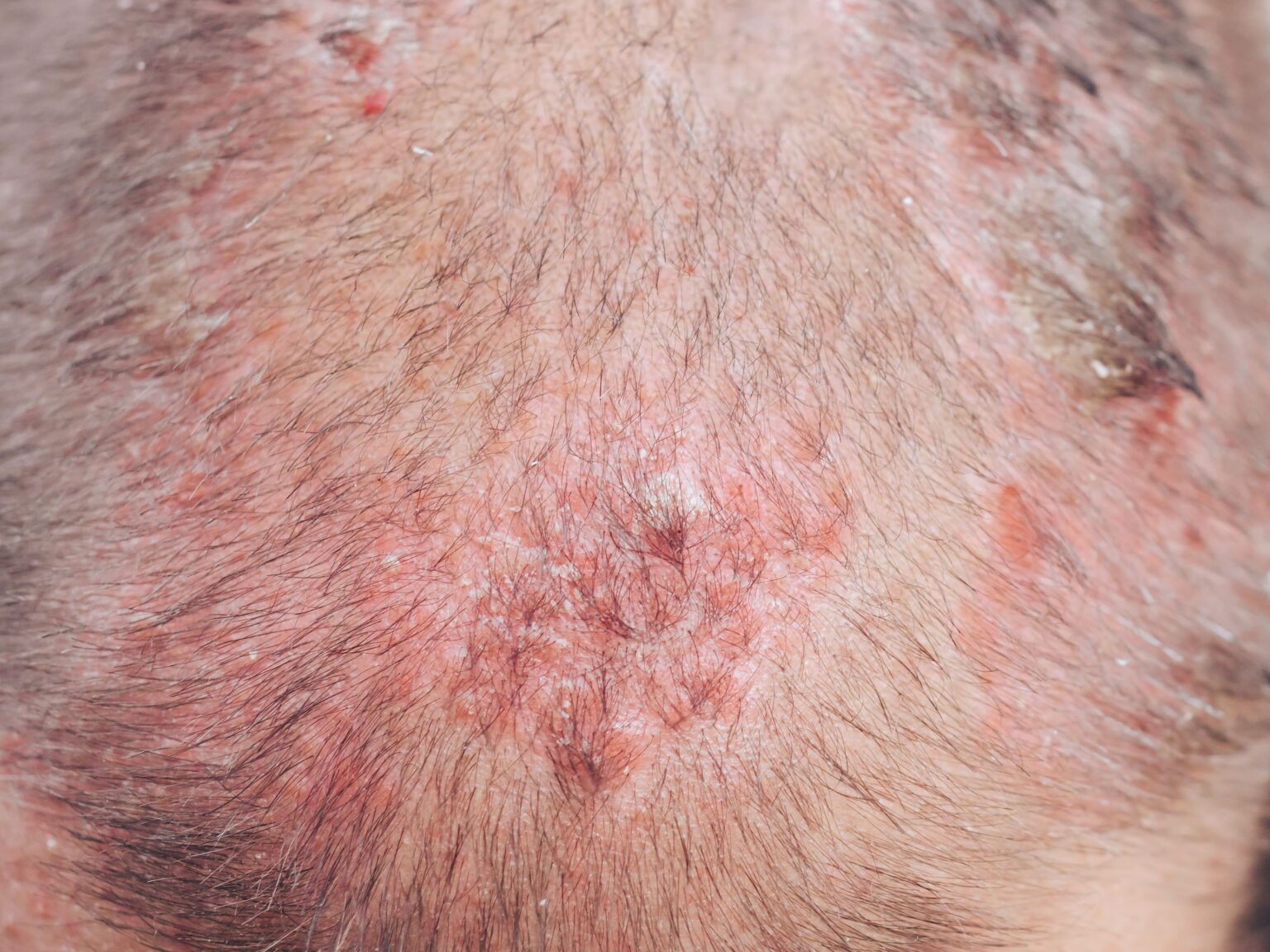 Boutons sur cuir chevelu après greffe de cheveux | Cosmedica
