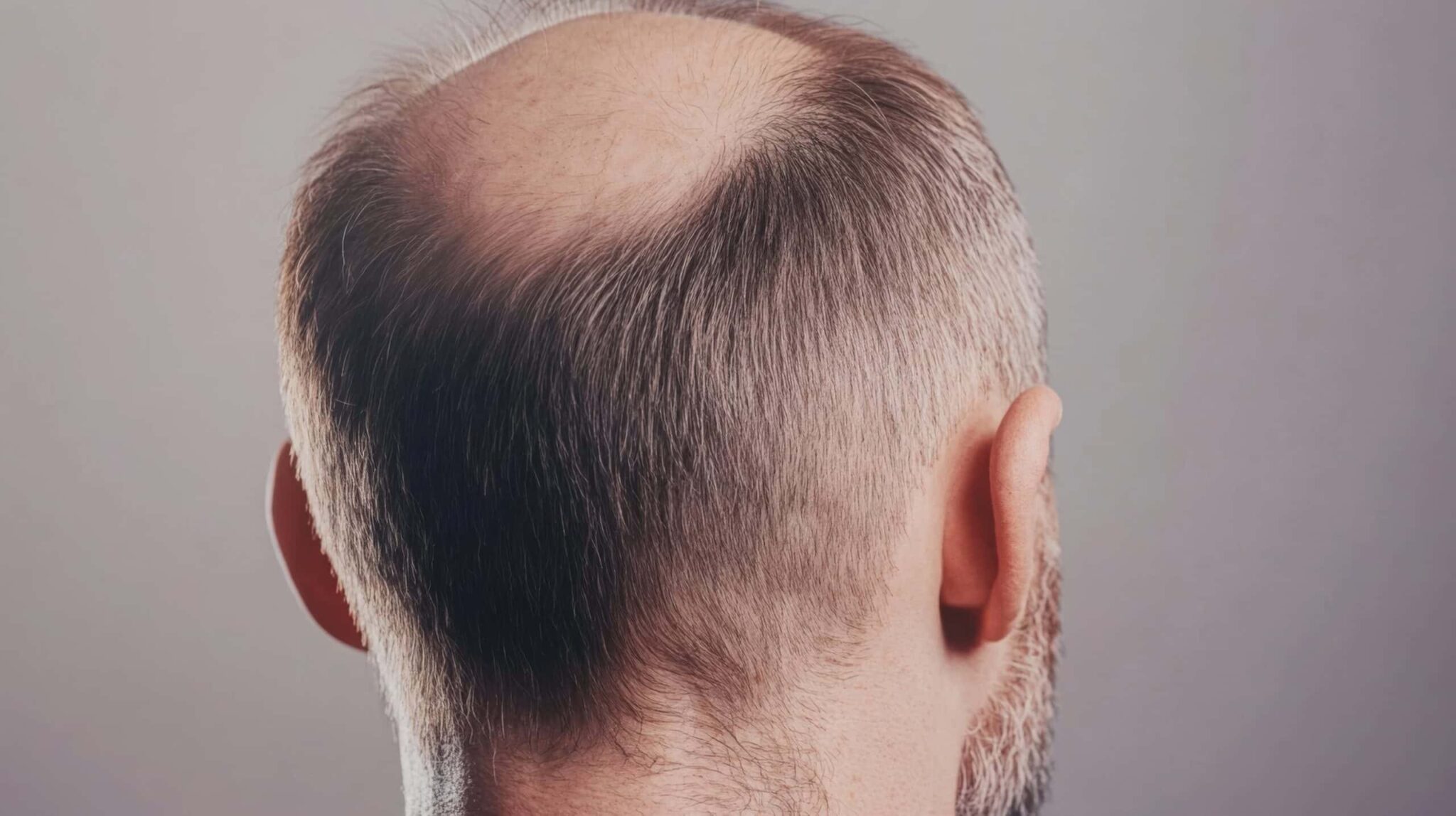 Trapianto di Capelli nella Corona: Che Cos'è? | Cosmedica
