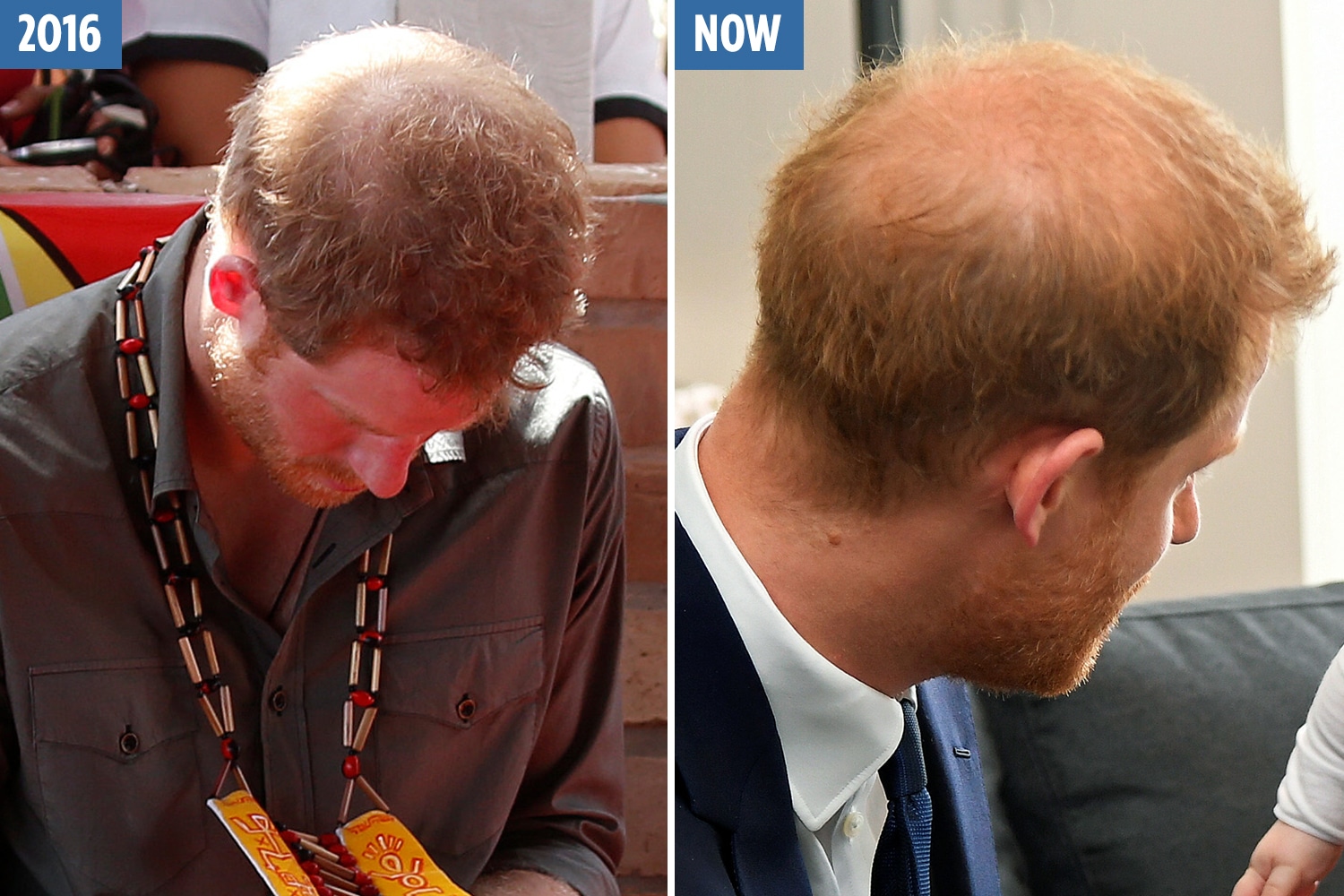 Prince Harry Hair Loss: Did He Get a Transplant? | Cosmedica