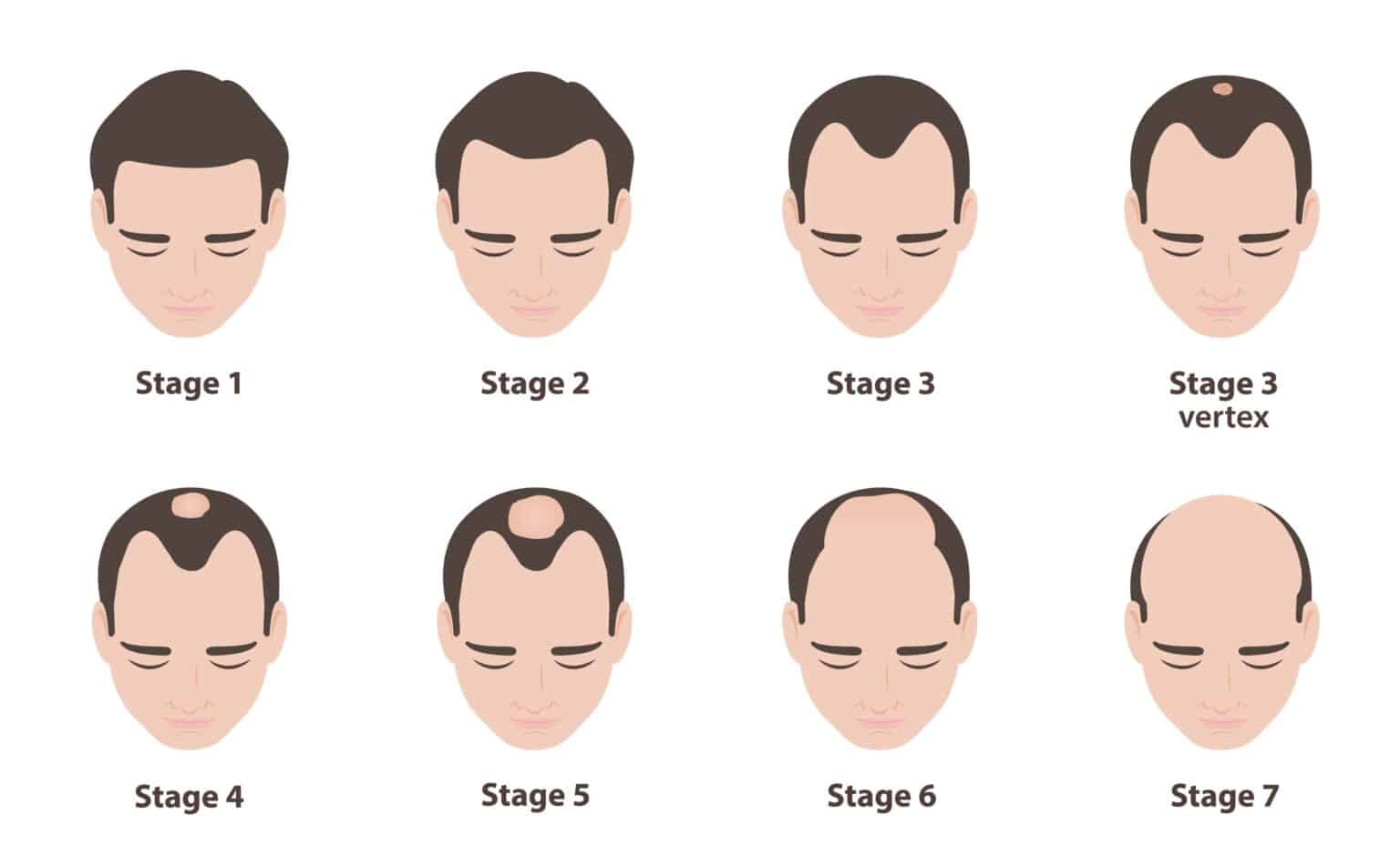 What Is the Norwood Hamilton Scale? | Cosmedica
