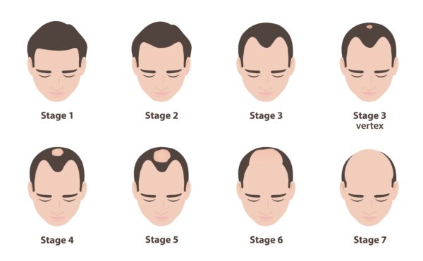 What Is the Norwood Hamilton Scale? | Cosmedica