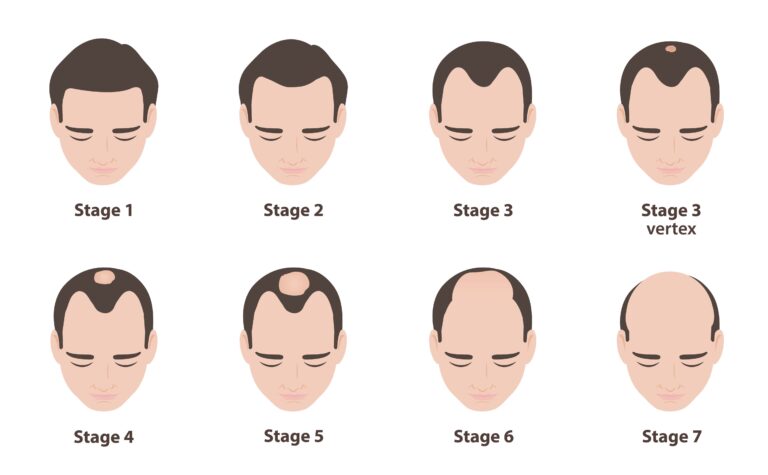 What Is the Norwood Hamilton Scale? | Cosmedica