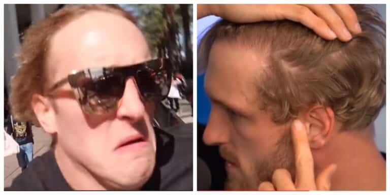 Logan Paul Hair Transplant. Did It Happen? | Cosmedica